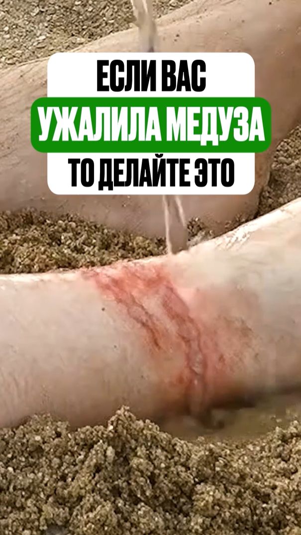 Что делать, если вас ужалила медуза?