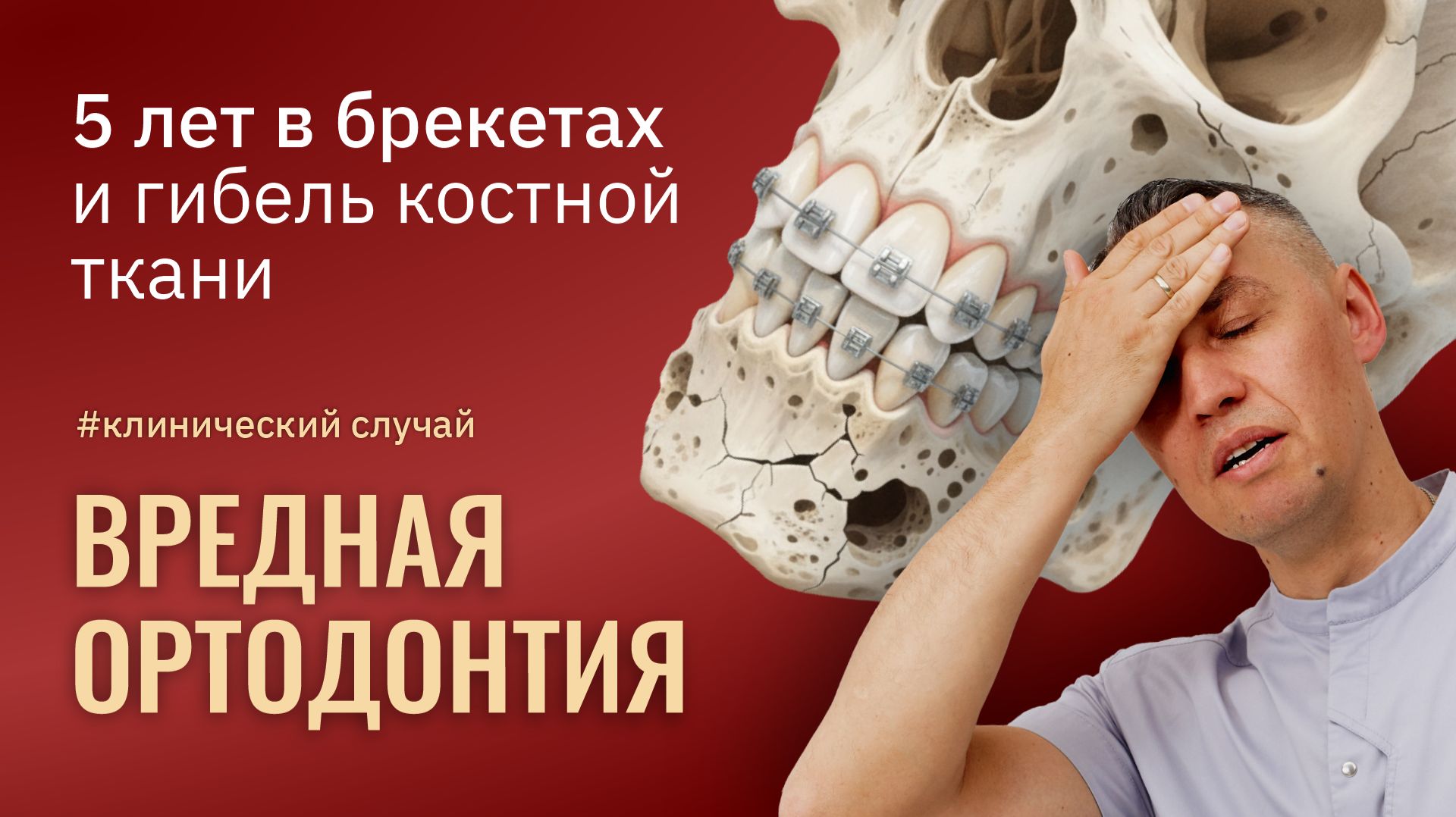 ВРЕДНАЯ ОРТОДОНТИЯ. 5 лет в брекетах и гибель костной ткани