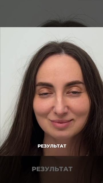 Эндоскопический лифтинг