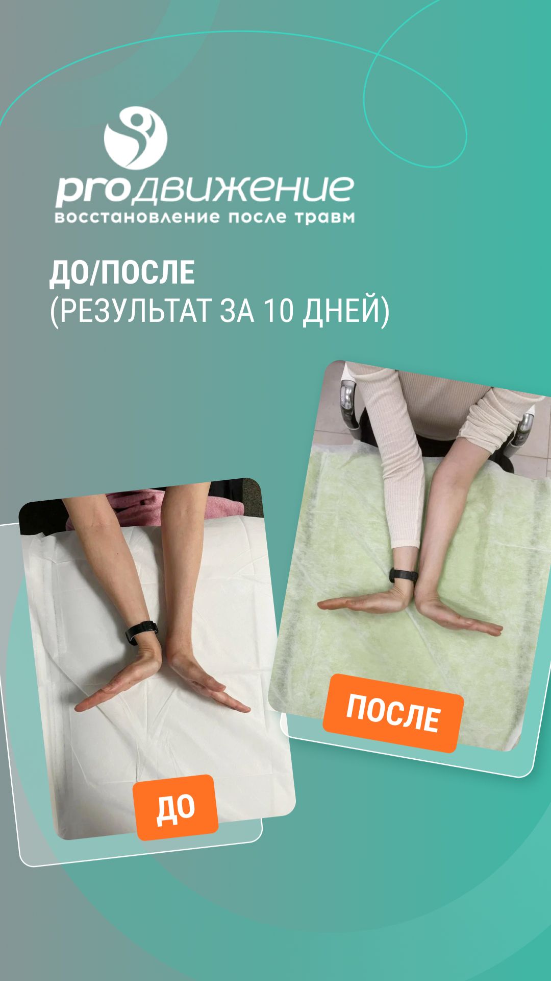 Как разработать руку после перелома лучевой кости (ДМЭ): программа восстановления в клинике