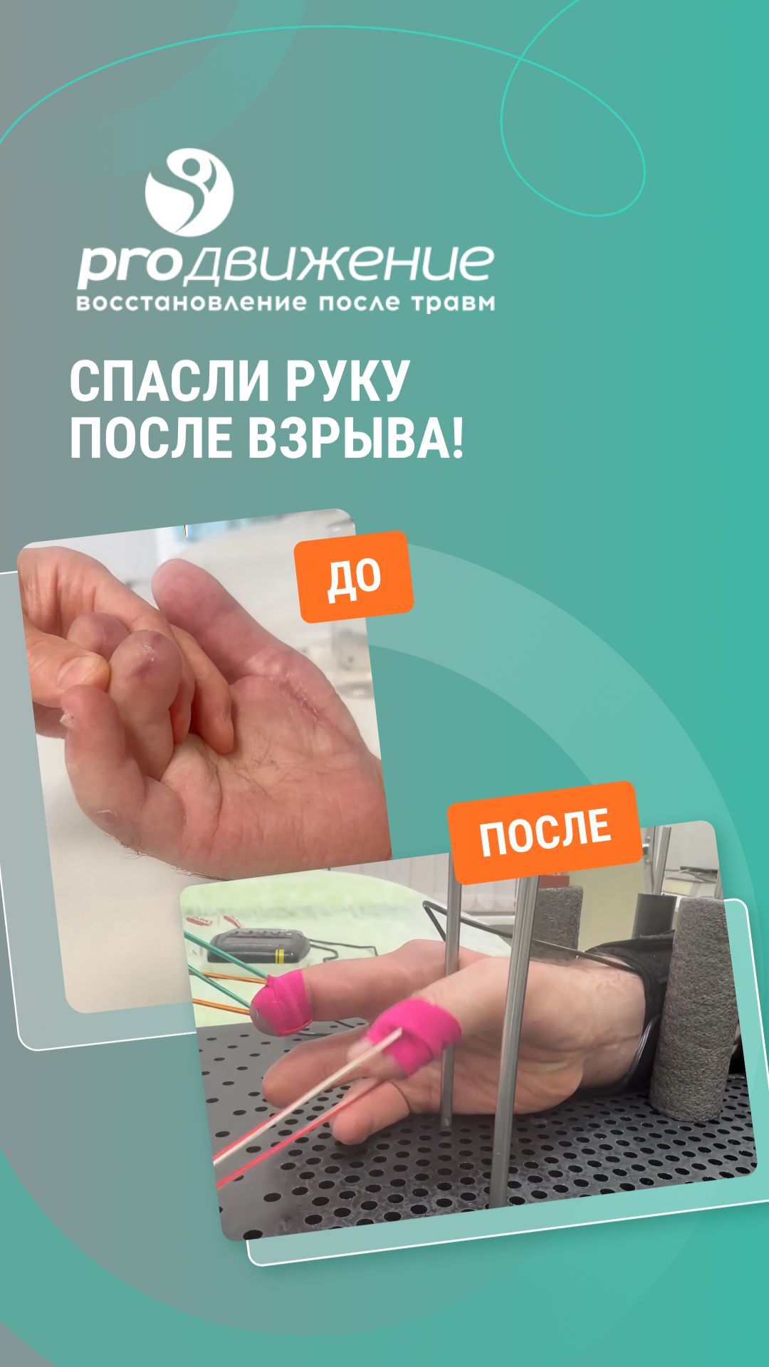 Травма руки от петарды: полное восстановление функций и реабилитация в клинике Продвижение