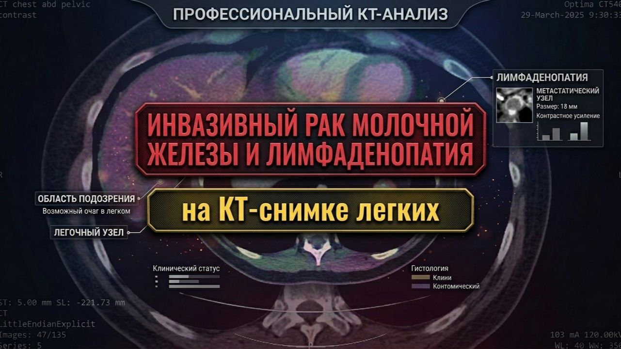 Инвазивная КАРЦИНОМА молочной железы и ЛИМФАДЕНОПАТИЯ молочной железы на КТ легких РАСШИФРОВКЕ