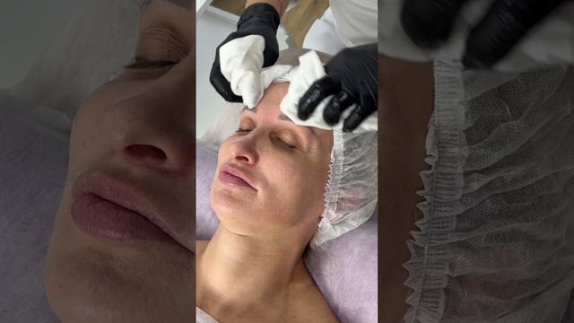 МАСТЕР-КЛАСС:  ПРОЦЕДУРА «НА ВЫХОД»  ♥Идеальное сочетание: iFiller Bioderm + Fusion Peel