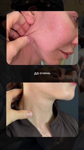 Две недели после СМАС-лифтинга