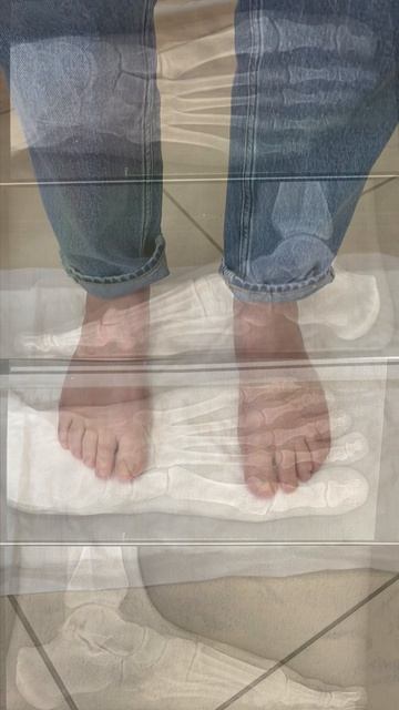 ❤️Отзыв пациентки: до и после лечения Hallux rigidus (ригидного пальца)