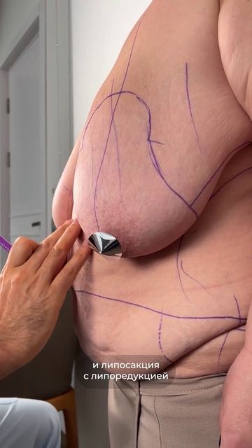 Комплексная операция после снижения веса на 40+ кг. Доктор Карапетян