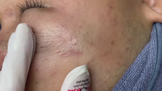 157 • Acne collection • АСМР • Relax Spa