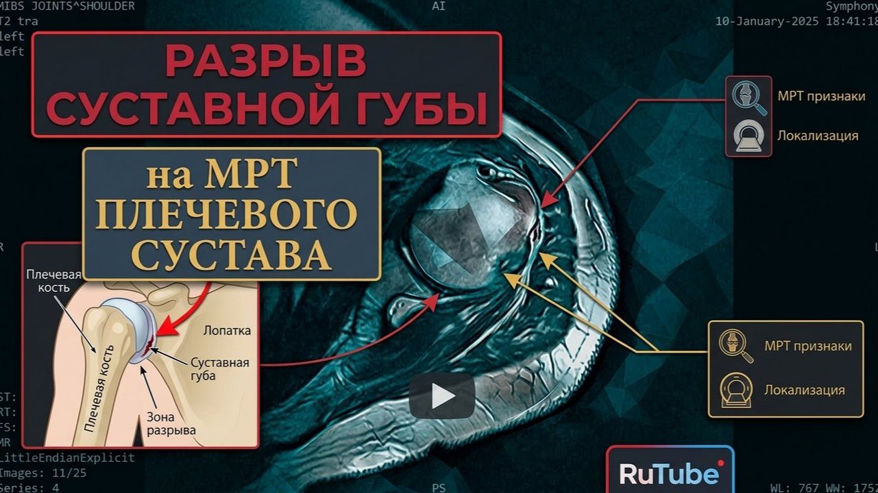 РАЗРЫВ суставной губы плеча SLAP 3, АРТРИТ-АРТРОЗ плечевого сустава на расшифровке МРТ плеча