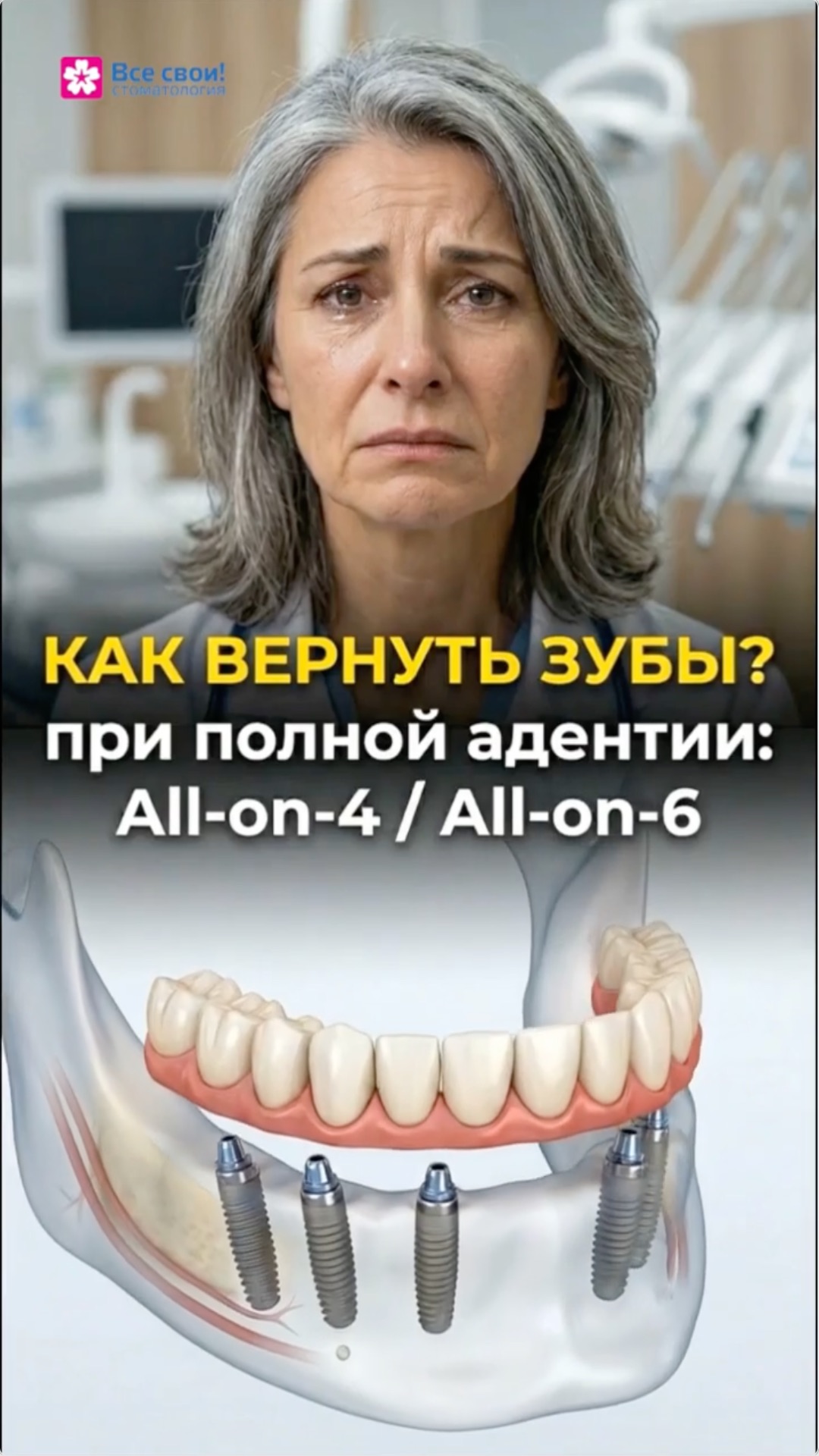 Нет всех зубов: как восстановить зубы методами All-on-4 и All-on-6