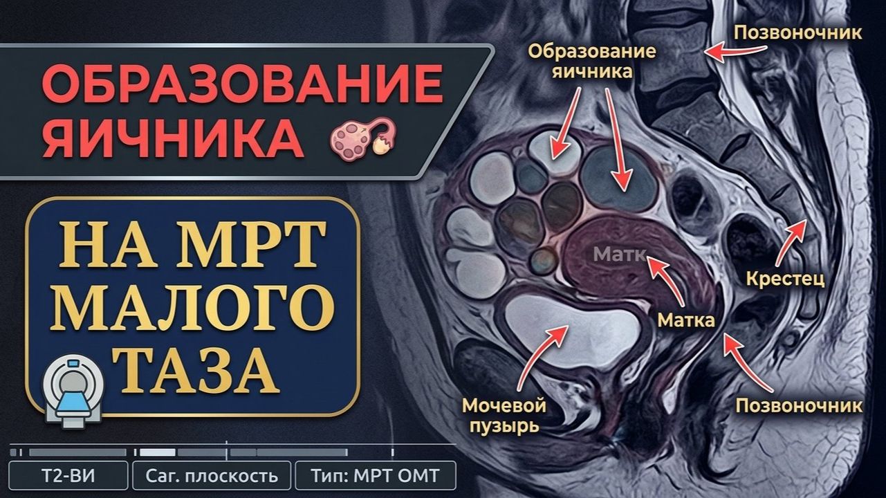 ОБРАЗОВАНИЕ ЯИЧНИКА женского (опухоль яичника у женщин) на РАСШИФРОВКЕ МРТ органов малого таза