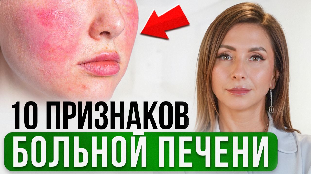 10 признаков, что ПЕЧЕНЬ БОЛЬНА! Как проверить здоровье печени?