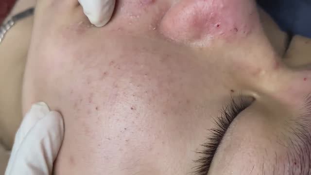 159 • Acne collection • АСМР • Relax Spa