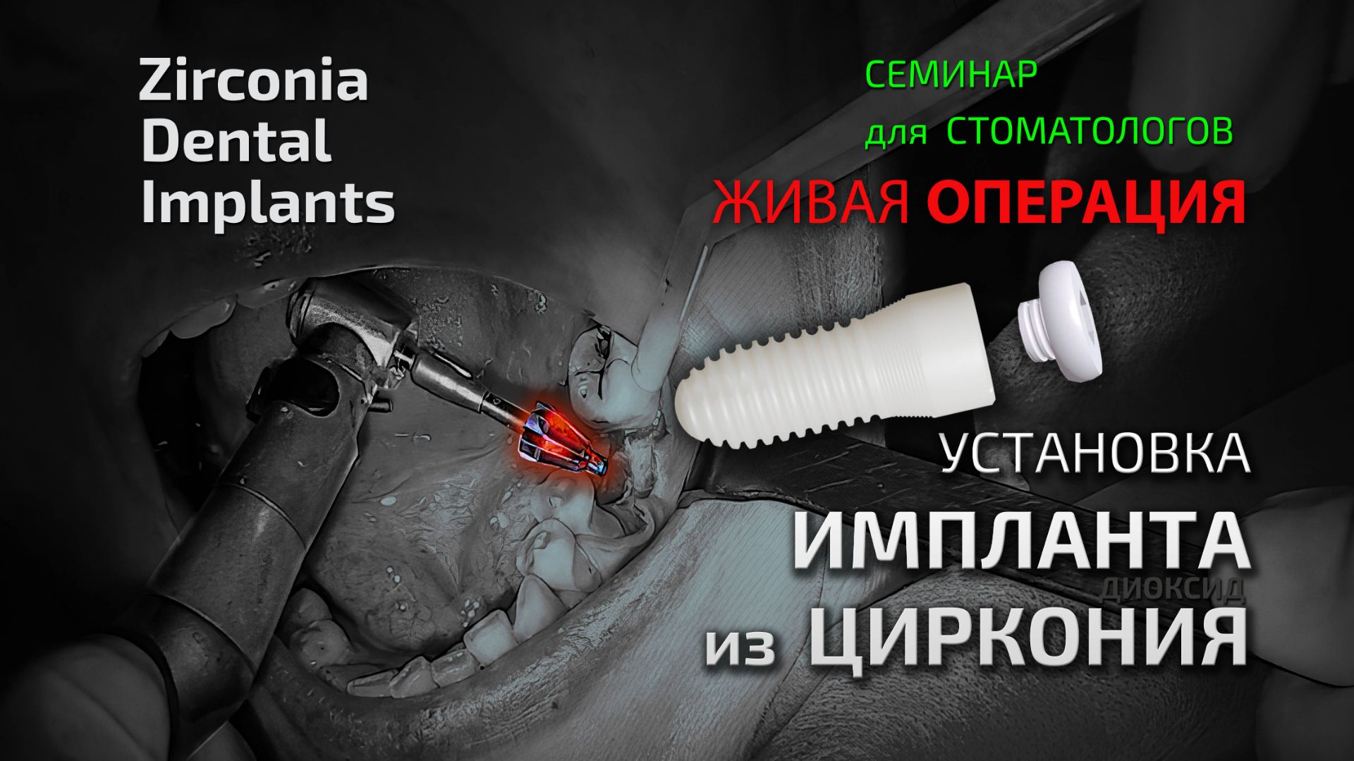 Лекция + живая операция для стоматологов + отзывы. Установка импланта из керамики