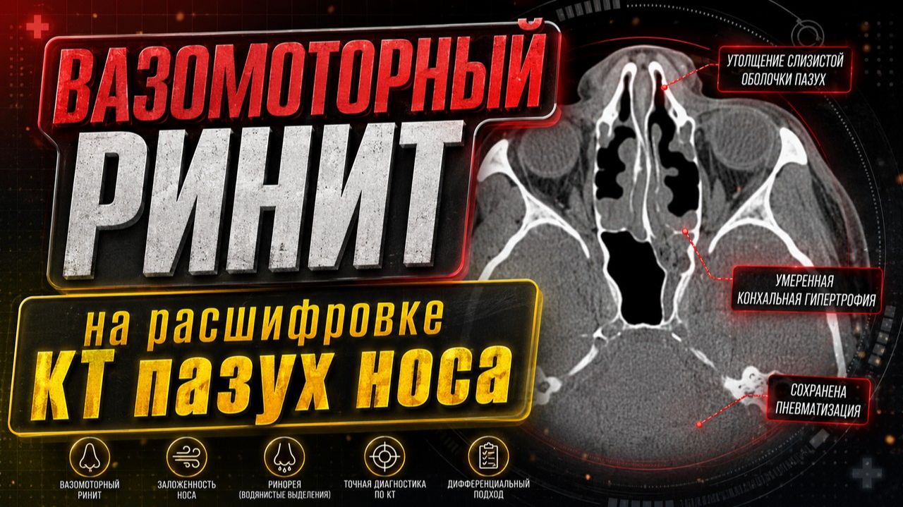 Как выглядит ИСКРИВЛЕНИЕ носовой перегородки и ВАЗОМОТОРНЫЙ РИНИТ на РАСШИФРОВКЕ КТ носовых пазух