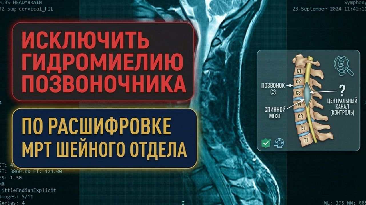 Исключение гидромиелии позвоночника при боли в спине на расшифровке (разборе) МРТ шейного отдела