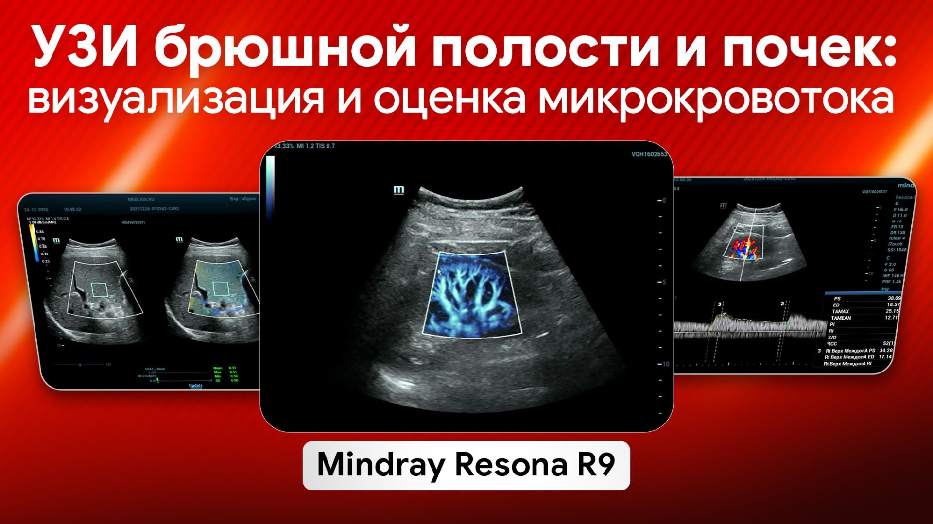 УЗИ брюшной полости и почек на Mindray Resona R9: эластография, оценка стеатоза и микрокровоток