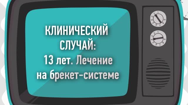 249. Клинический случай: Лечение на брекет-системе, 13 лет. Стоматологическая клиника Натадент