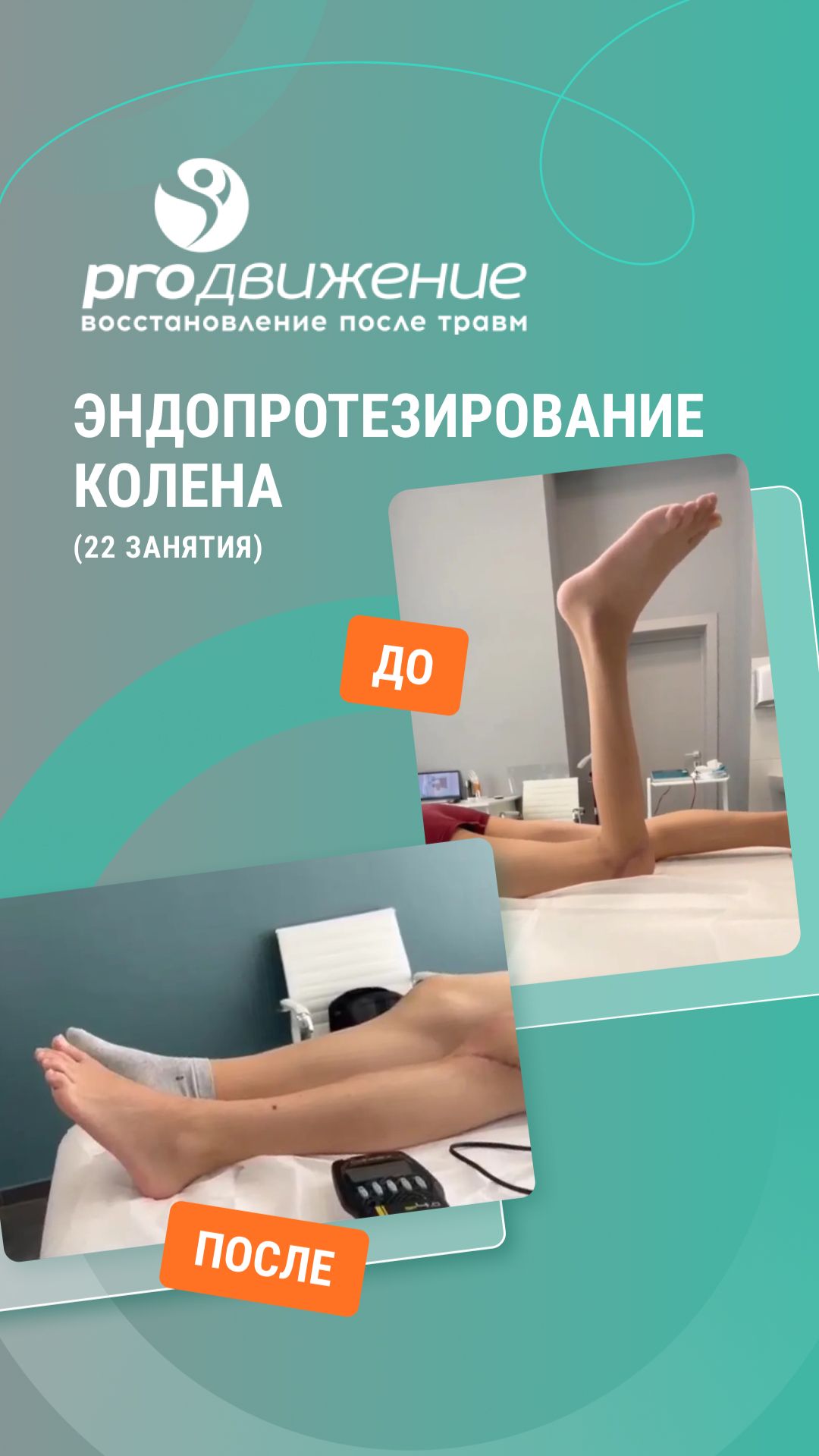 Жизнь после остеосаркомы: путь к движению 🦵✨ Эндопротезирование левого коленного сустава