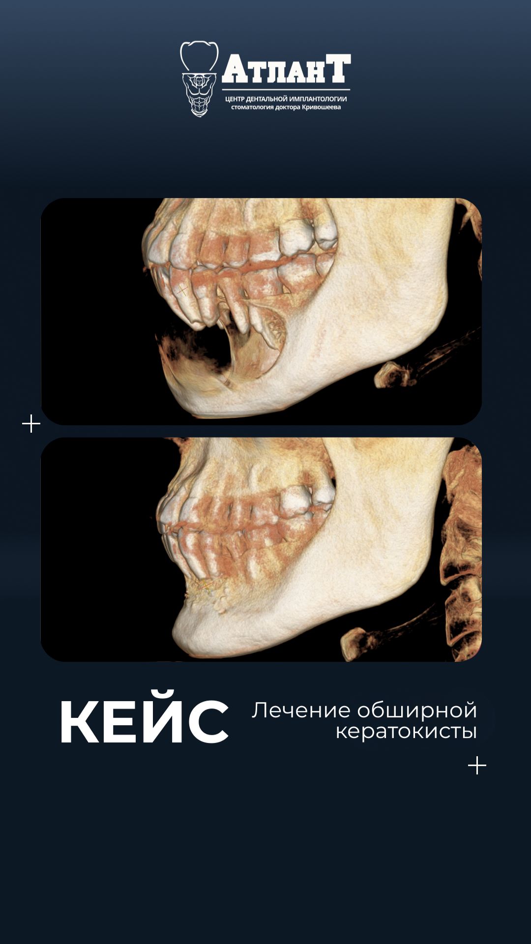 Лечение обширной кератокисты нижней челюсти с сохранением зубов. Кейс клники "Атлант" #shorts