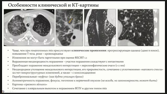 Метастазы легких (лекция + разбор лучевых изображений)