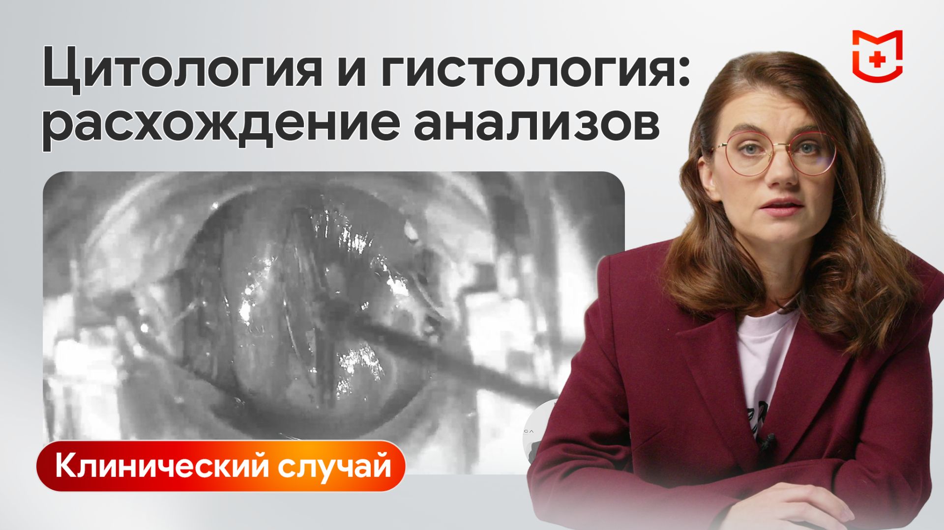 Клинический разбор: расхождение цитологии и гистологии при кольпоскопии