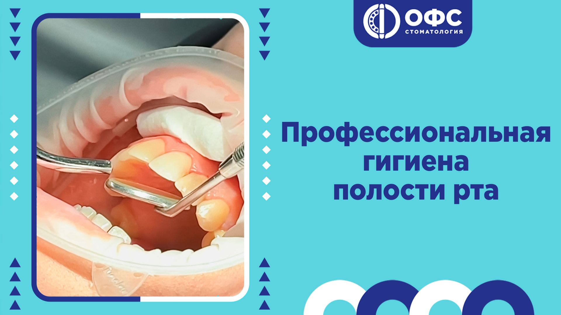 Профессиональная гигиена полости рта в клинике "ОФС Стоматология"