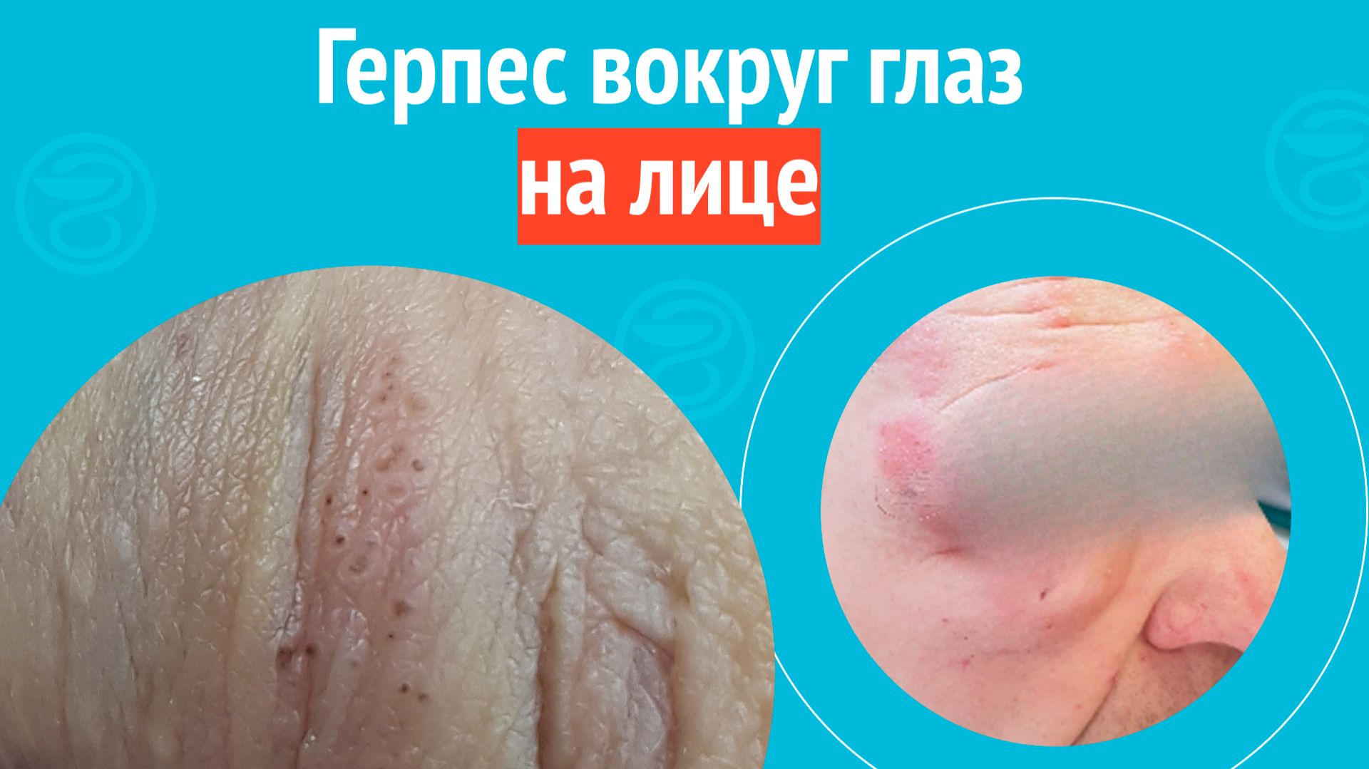 👀 Герпес вокруг глаз на лице. Клинический случай № 1799