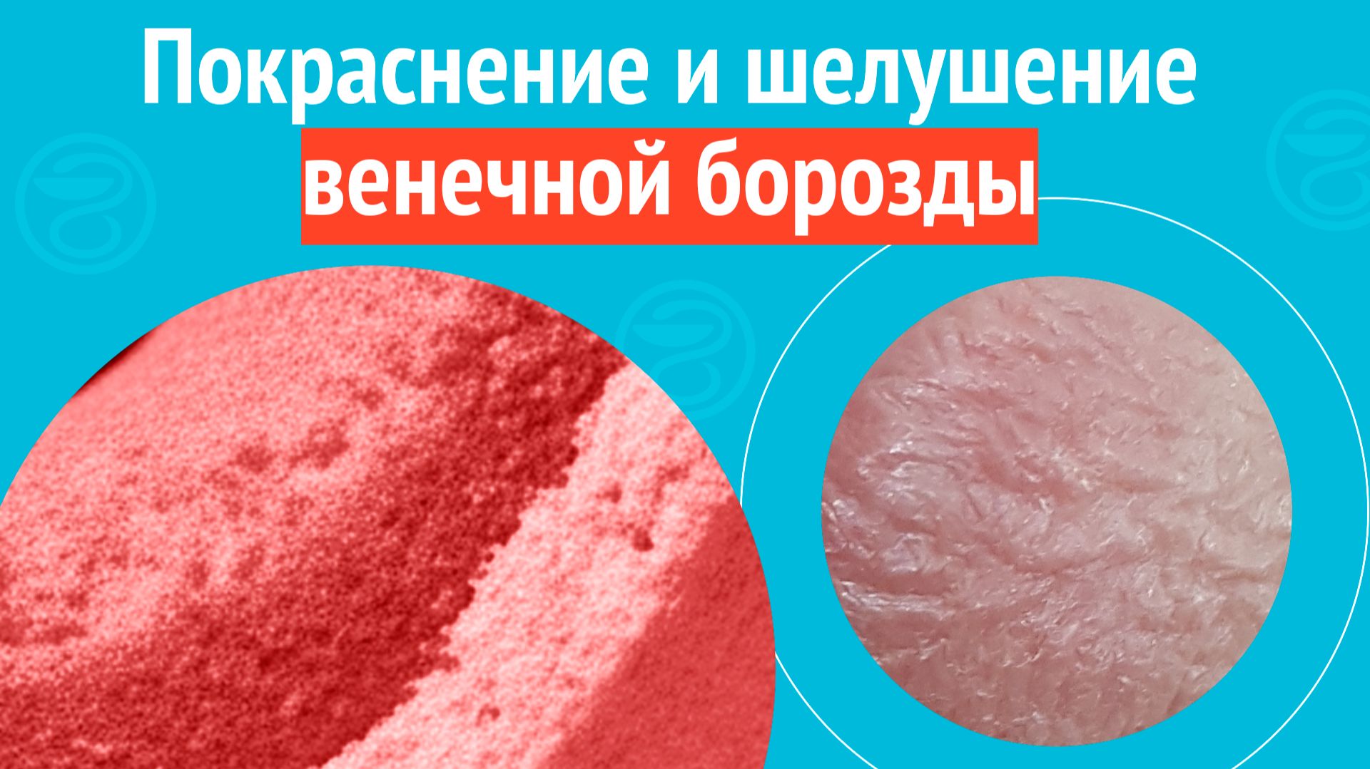 😡 Покраснение и шелушение венечной борозды. Клинический случай № 1797