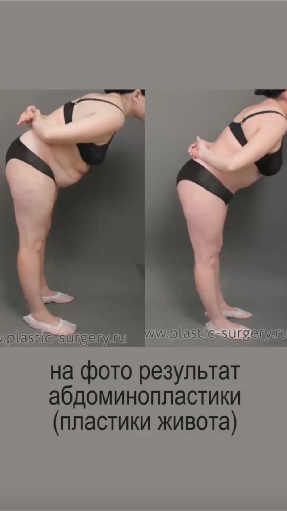 Пластика живота после родов: абдоминопластика до/после