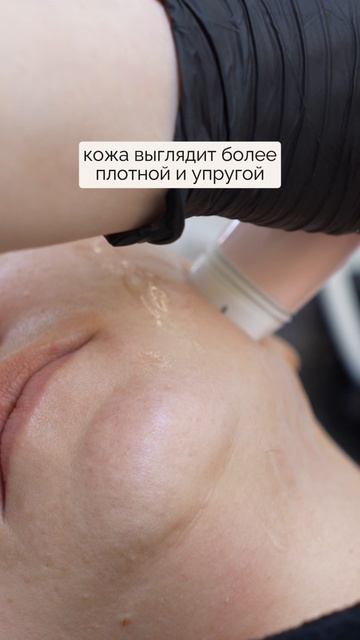 RF-лифтинг Volnewmer в «Бест Клиник»