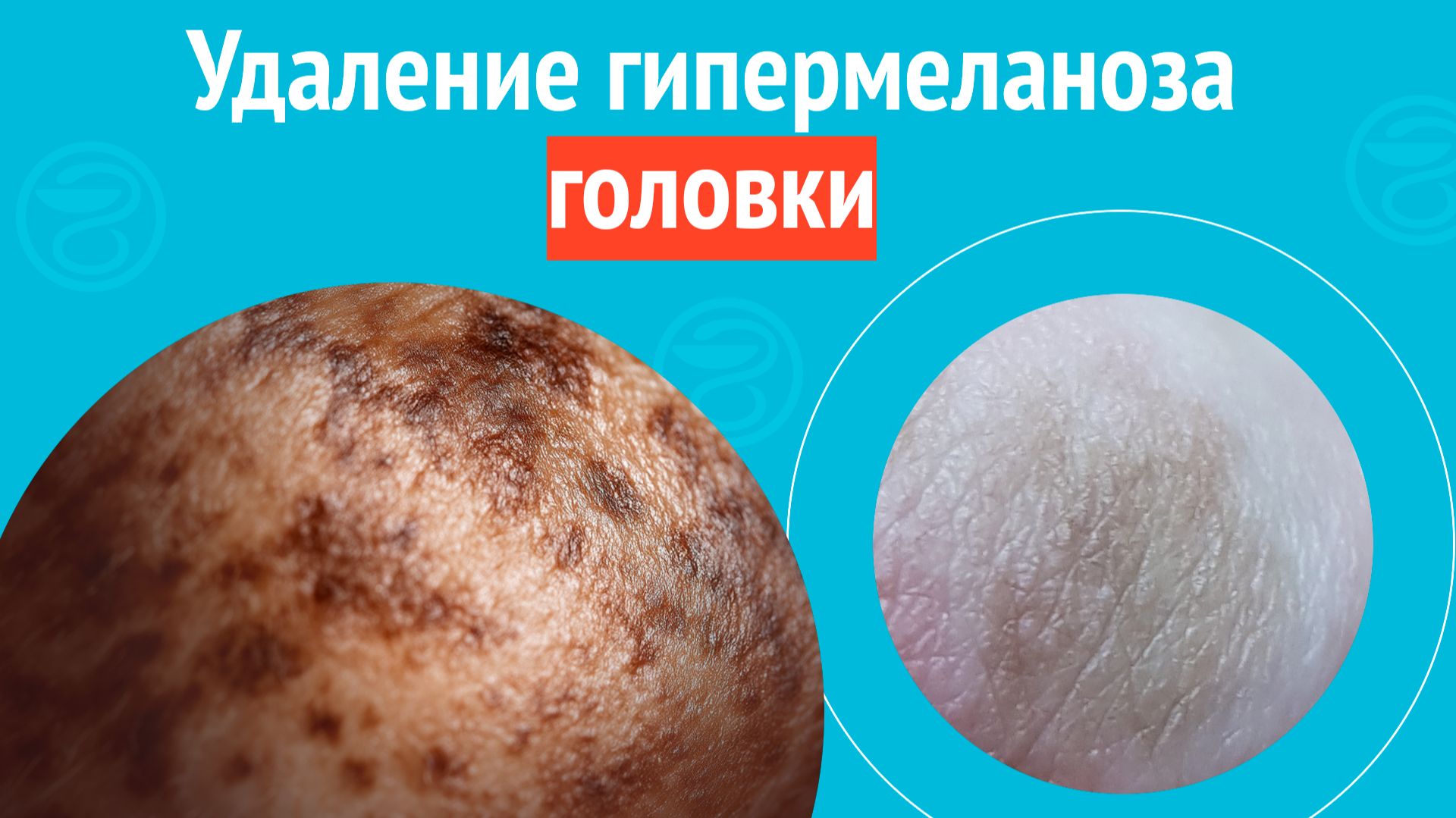 🙁 Удаление гипермеланоза головки. Клинический случай № 1800