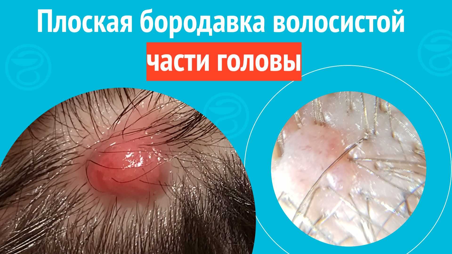 😕 Плоская бородавка волосистой части головы. Клинический случай № 1801