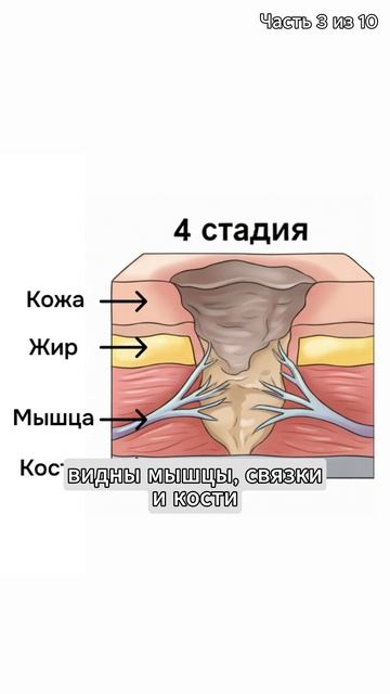 3 часть: Пролежни: лечение и профилактика ✔️