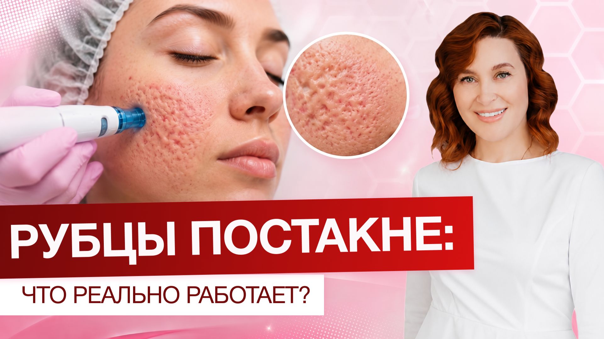 Как убрать рубцы постакне? Аппаратные методики и Ферменкол.