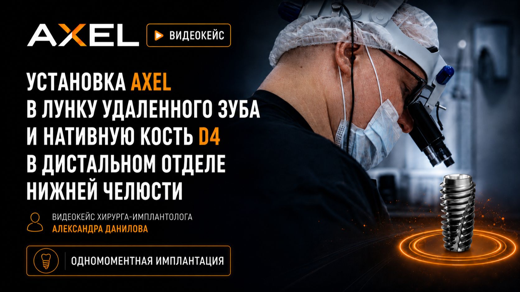 УСТАНОВКА ИМПЛАНТАТА AXEL В ЛУНКУ УДАЛЕННОГО ЗУБА И НАТИВНУЮ КОСТЬ ТИПА D4