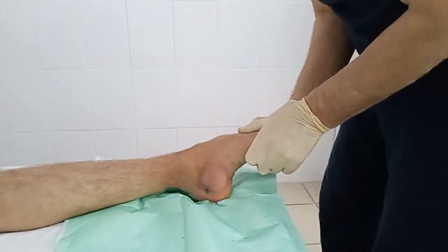Разрыв Ахилла часто сопровождается подвывихами в стопе