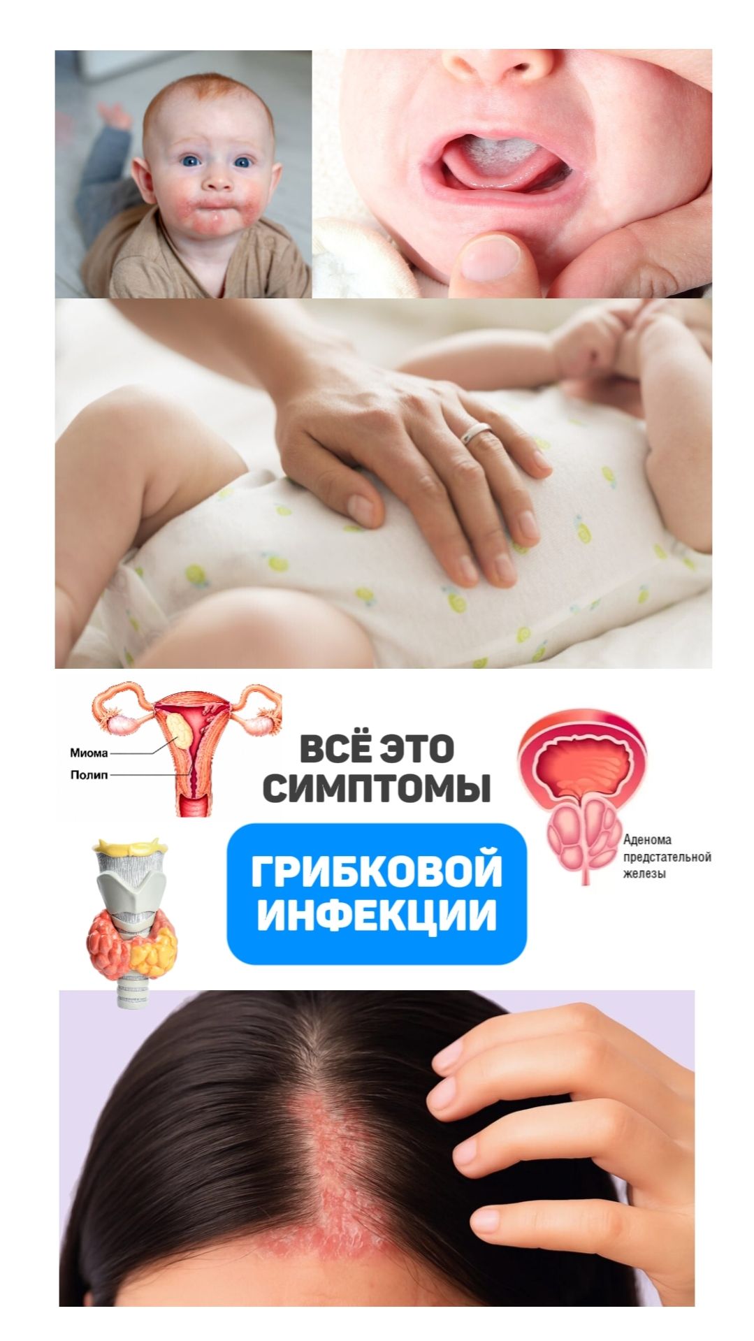 Симптомы грибковой инфекции. Семейный доктор Алена Братишко