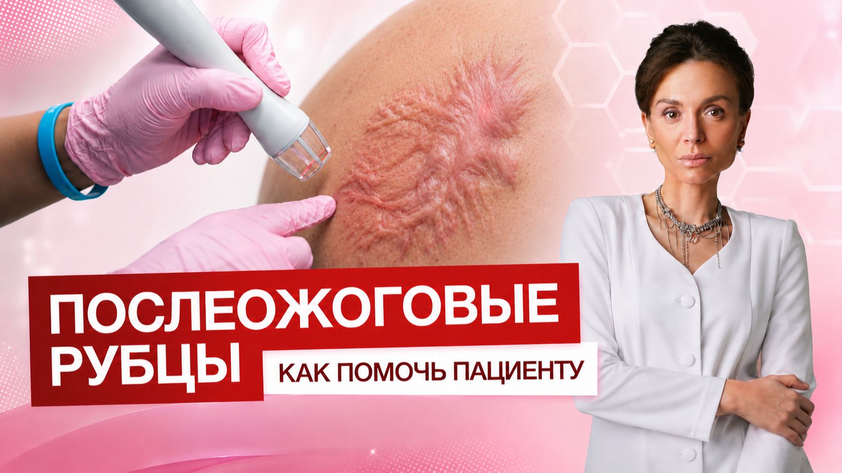 Протокол коррекции послеожоговых рубцов: клинический кейс