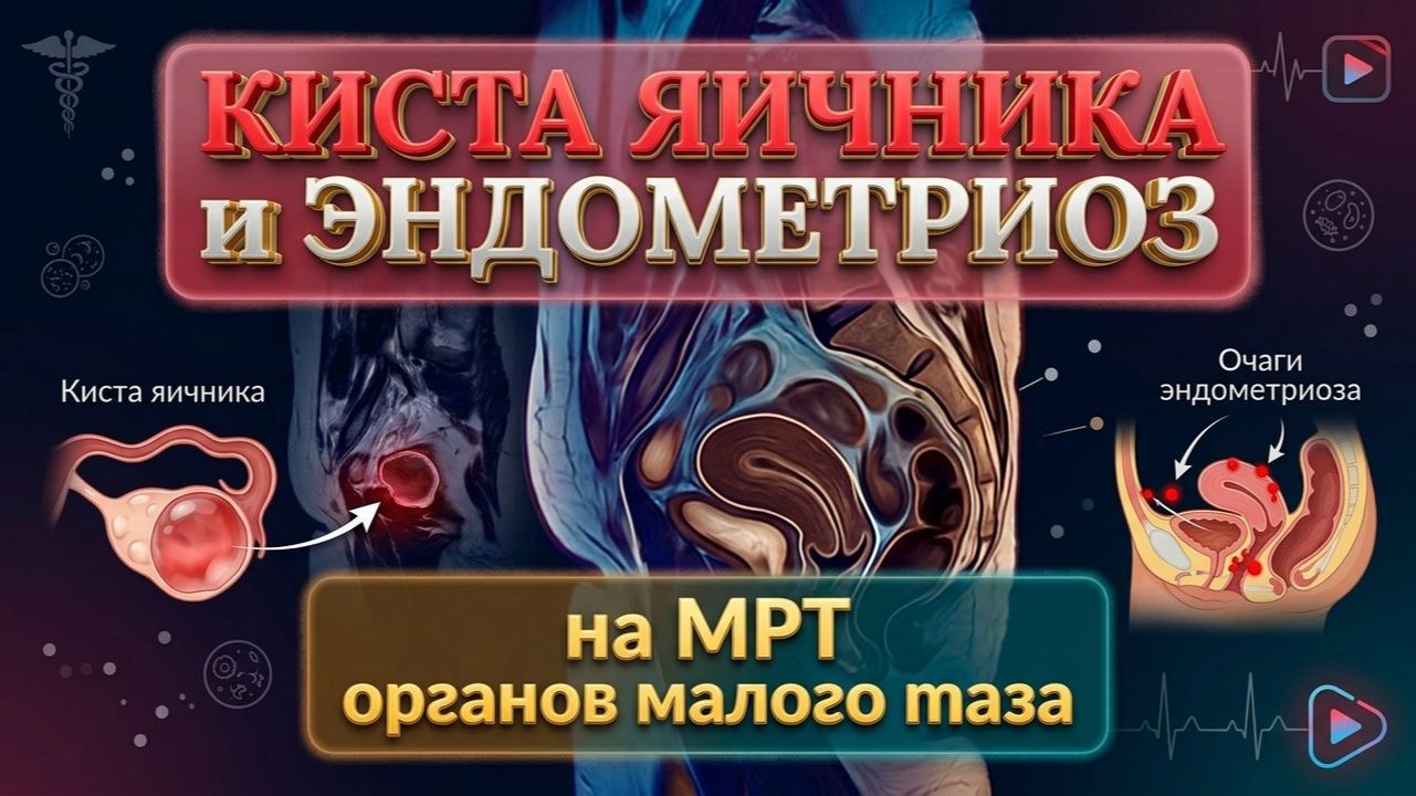 ЭНДОМЕТРИОЗ матки и КИСТА ЛЕВОГО ЯИЧНИКА (симптомы) на РАСШИФРОВКЕ МРТ малого таза у женщин