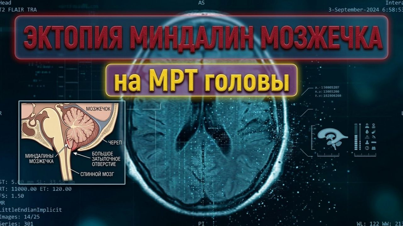 КИСТА в носовой пазухе, смешанная ГИДРОЦЕФАЛИЯ при шуме в ушах на РАСШИФРОВКЕ МРТ головного мозга