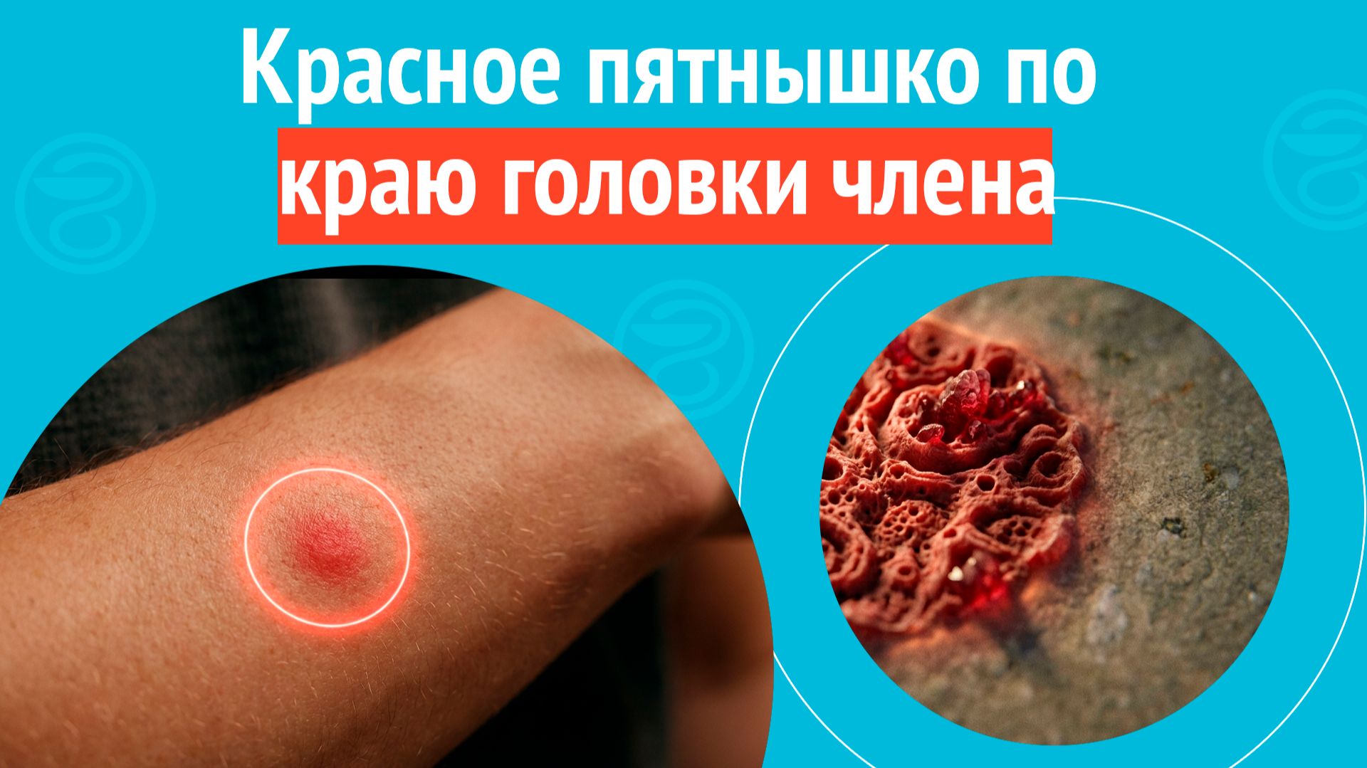 😡 Красное пятнышко по краю головки члена. Клинический случай № 1809