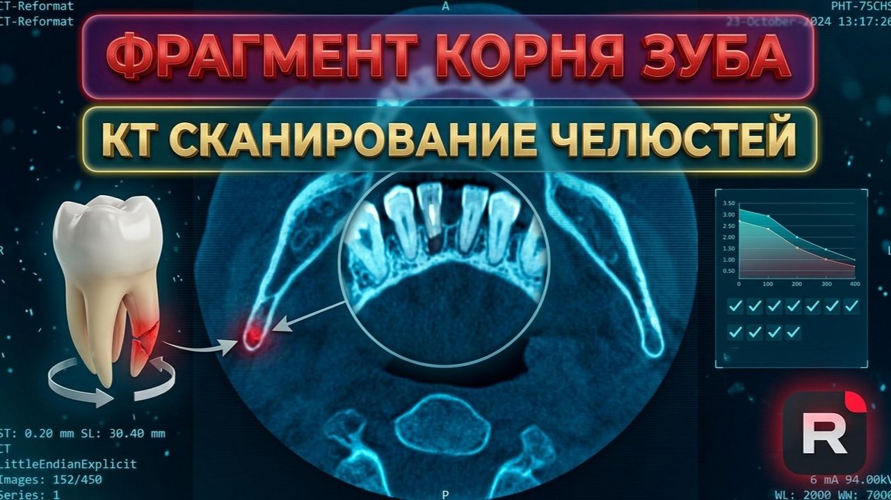 КОРЕНЬ ЗУБА (фрагмент), признаки ПЛОМБЫ ЗУБА после эндодонтического лечения на РАСШИФРОВКЕ КТ зубов