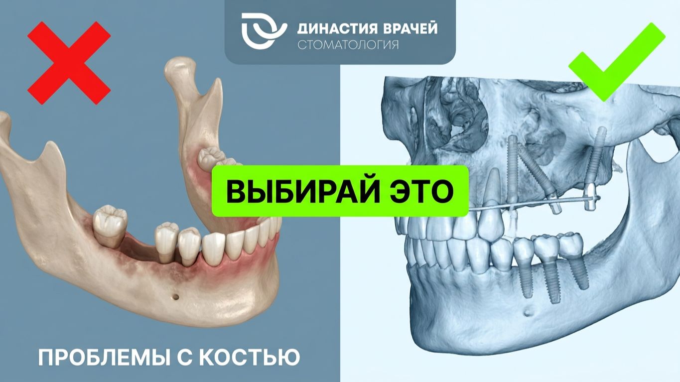 Без костной пластики и синус-лифтинга? Реально! 😱