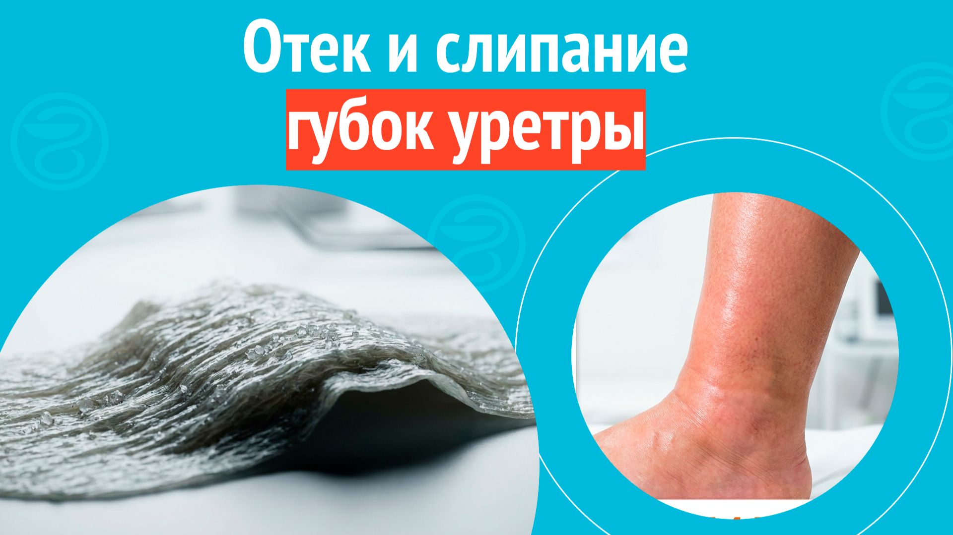 😦 Отек и слипание губок уретры. Клинический случай № 1810