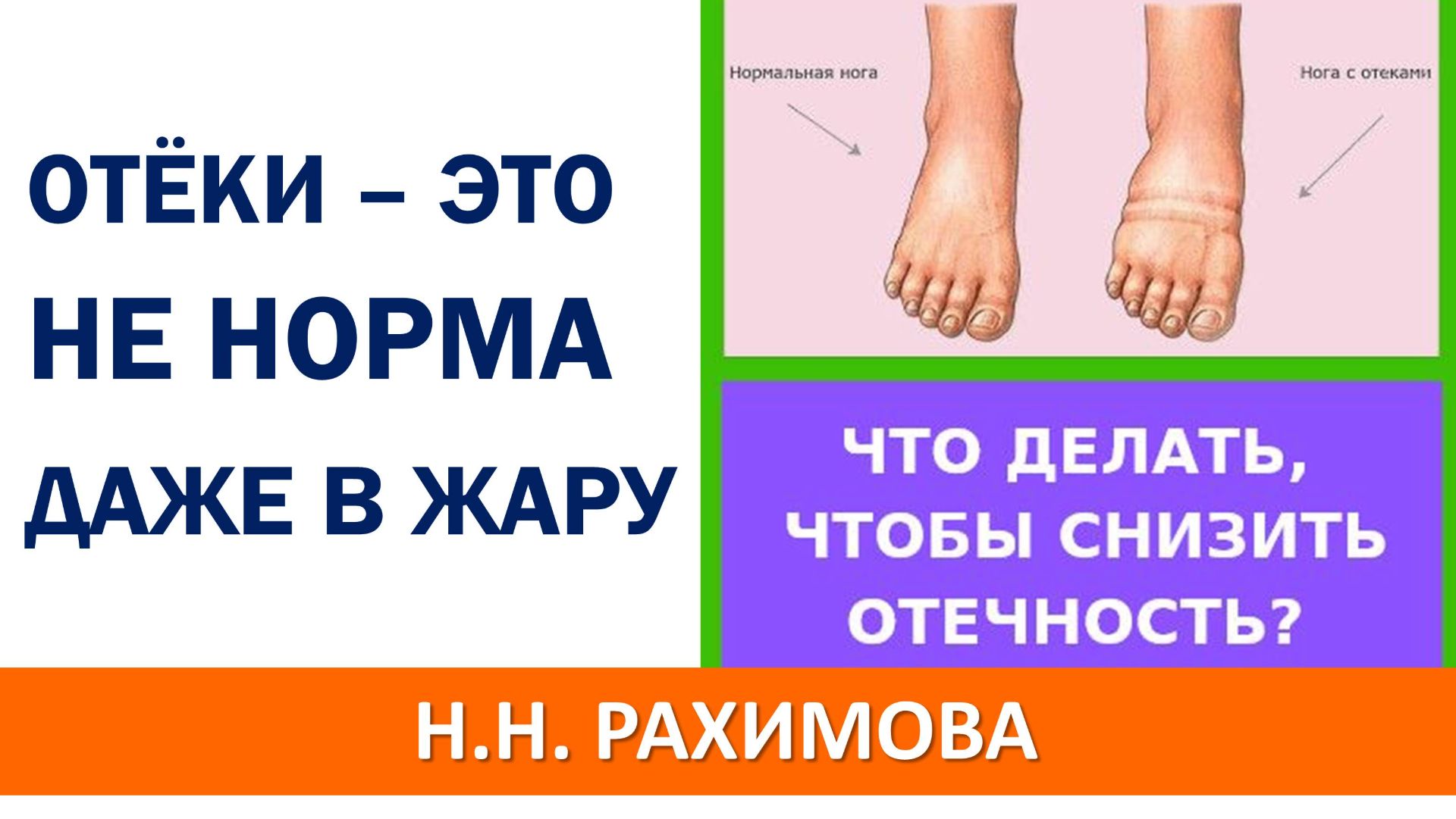 Отёки - это не норма даже в жару