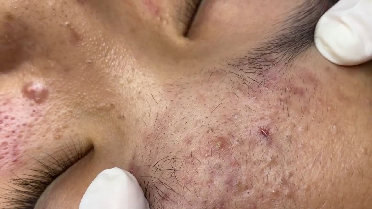 253 • Acne collection • АСМР • Relax Spa