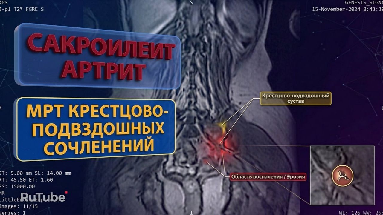 Двусторонний САКРОИЛЕИТ (артрозо артрит) на РАСШИФРОВКЕ МРТ крестцово-подвздошных сочленений