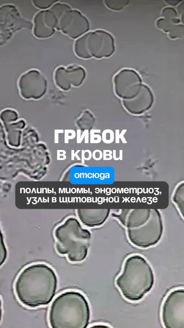 Полипы, миомы, эндометриоз, узлы в щитовидной железе появляются из-за грибковой инфекции