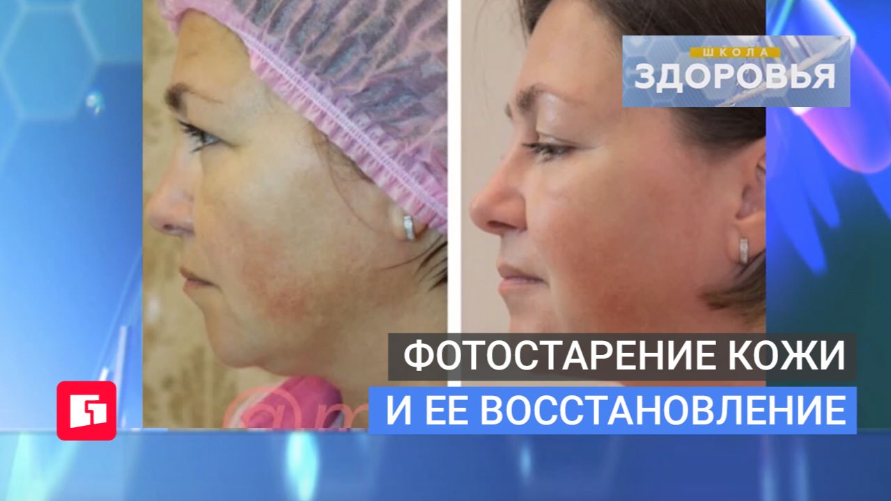 Фотостарение кожи и ее восстановление. Школа здоровья. GuberniaTV