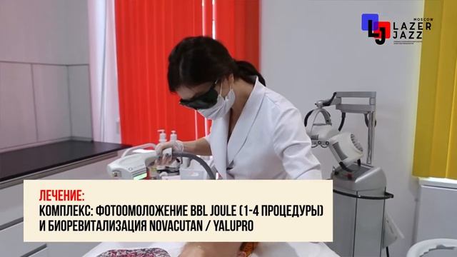 Пигментные пятна на лице как избавиться - фотоомоложение BBL